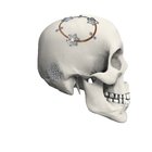 Skull Orthopedic Surgery Equipment Drainage Cranial Interlink Titanium Plate